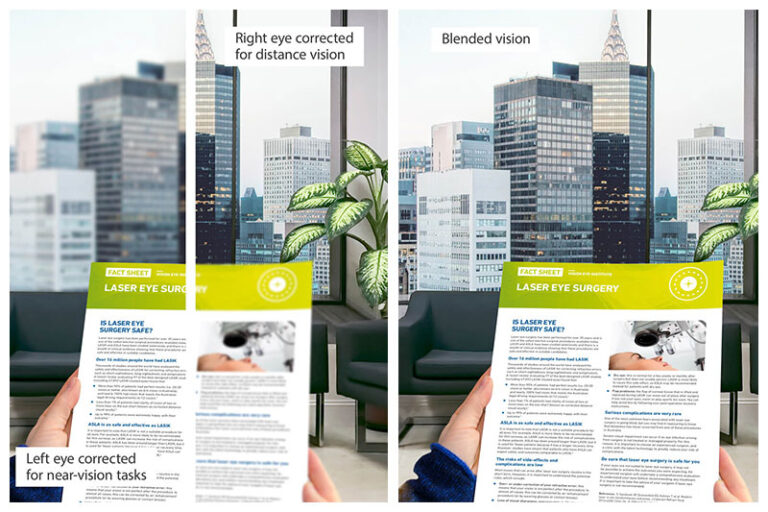 Monovision – phoenixcataract